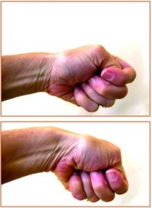 de Quervain's Tendonitis Orange County - Fountain Valley