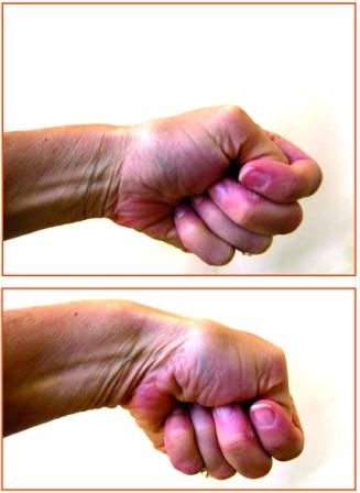 de Quervain's Tendonitis Orange County - Fountain Valley