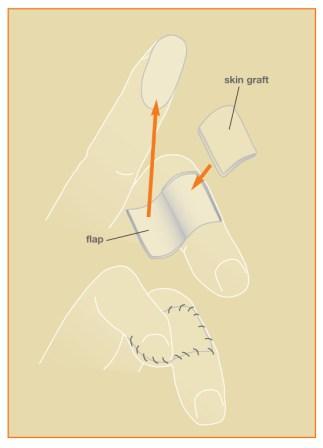 Fingertip Injuries Orange County - Fountain Valley