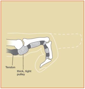 Trigger Finger Orange County - Trigger Finger Fountain Valley